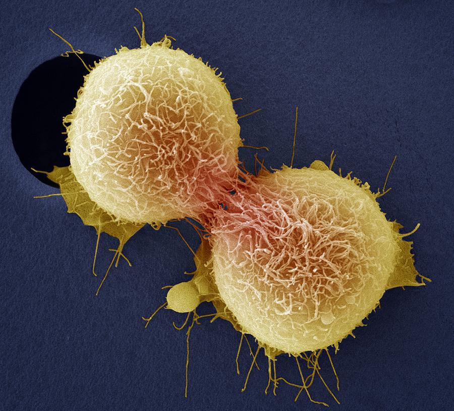 Cervical Cancer Cell Division Sem Photograph By Steve Gschmeissner