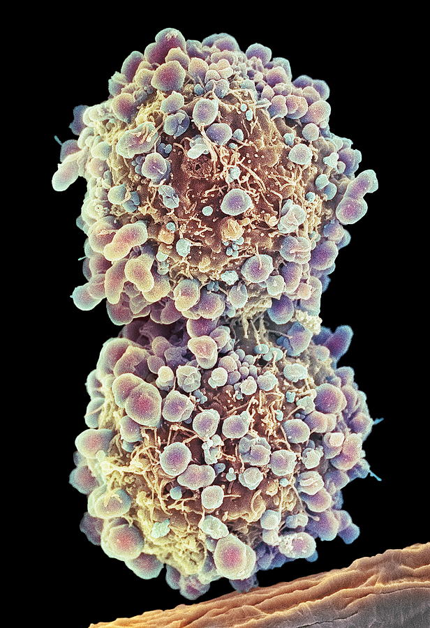 Cervical Cancer Cells Dividing Sem Photograph By Steve Gschmeissner