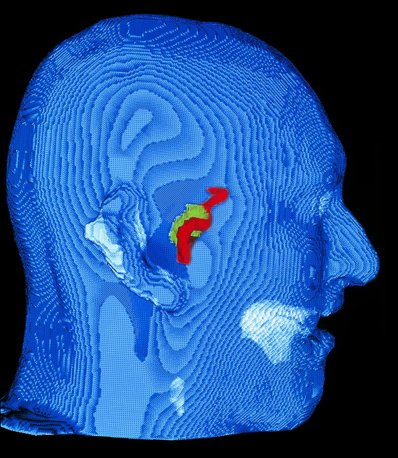 Coloured 3-d Mri Scan Of A Brain Cyst Photograph by Geoff Tompkinson - Fine Art America