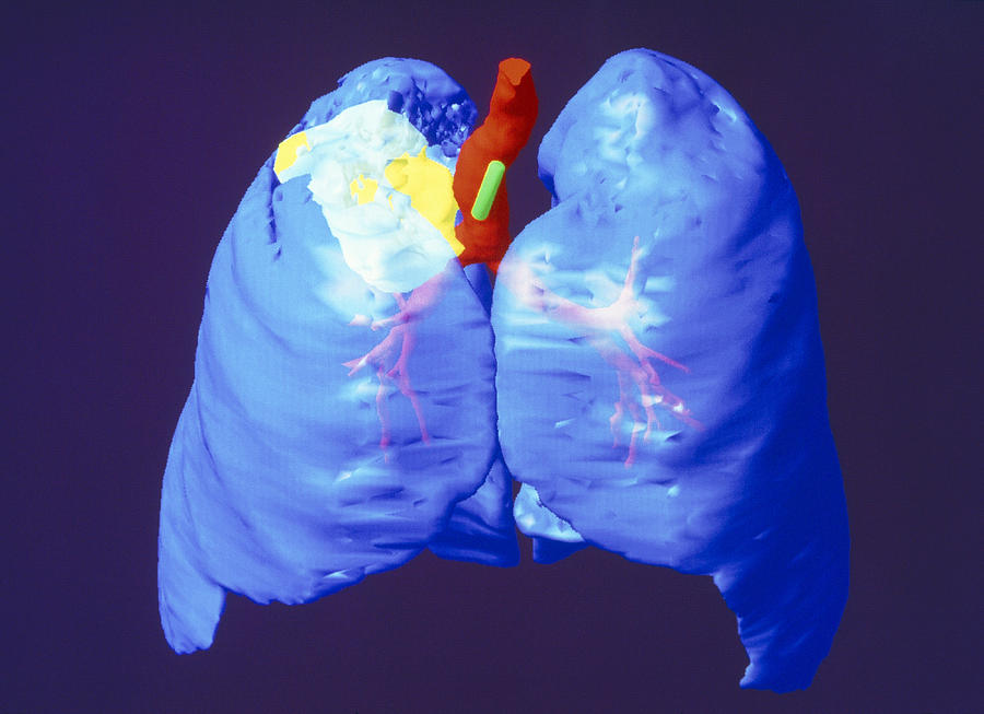 Coloured Computed Tomography Scan Of Lung Cancer Photograph by Volker ... Coloured Computed Tomography Scan Of Lung Cancer Photograph by Volker ...