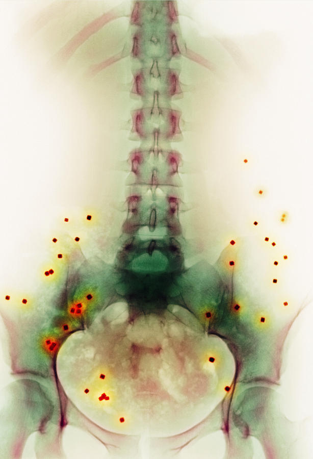 Constipation Markers, X-ray by Cnri / Science Photo Library