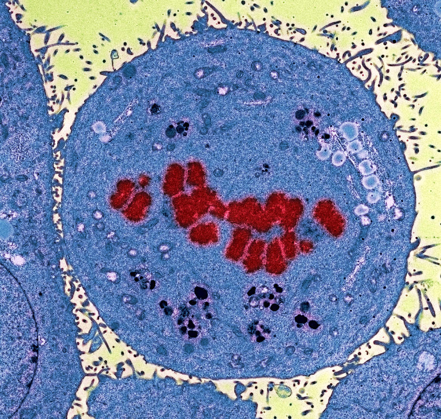 Dividing Carcinoma Cell, Tem Photograph by Steve Gschmeissner | Fine ...