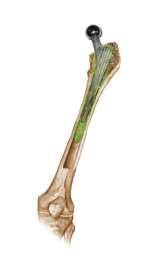 Failed Hip Replacement, Composite Image by Science Photo Library