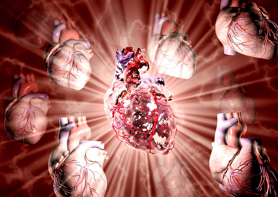Heart Attack by Science Photo Library