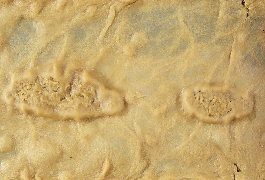 Intestinal Typhoid Ulcers Photograph by Dr. E. Walker | Pixels