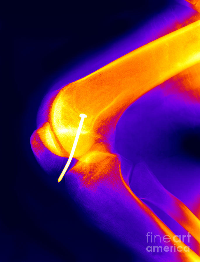 Knee X Ray Photograph By Ted Kinsman