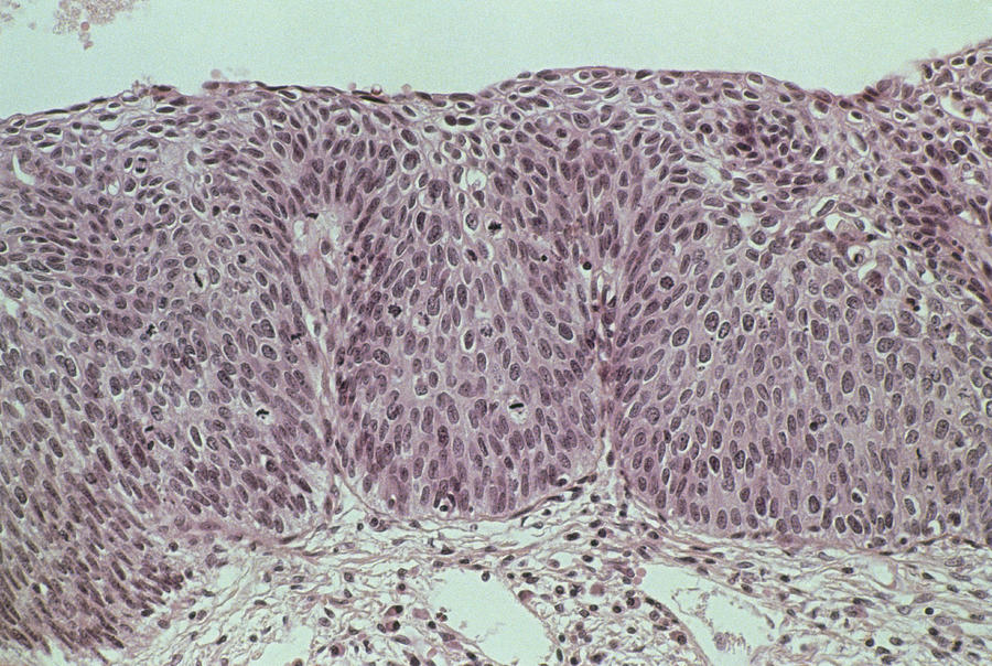 Lm Of Grade Iii Cervical Intraepithelial Neoplasia Photograph By Dr E Hot Sex Picture