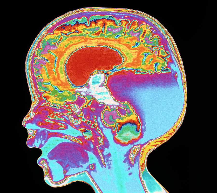 Mri Scan Of Brain Cyst In 11 Month Old Child Photograph by Mehau Kulyk - Fine Art America