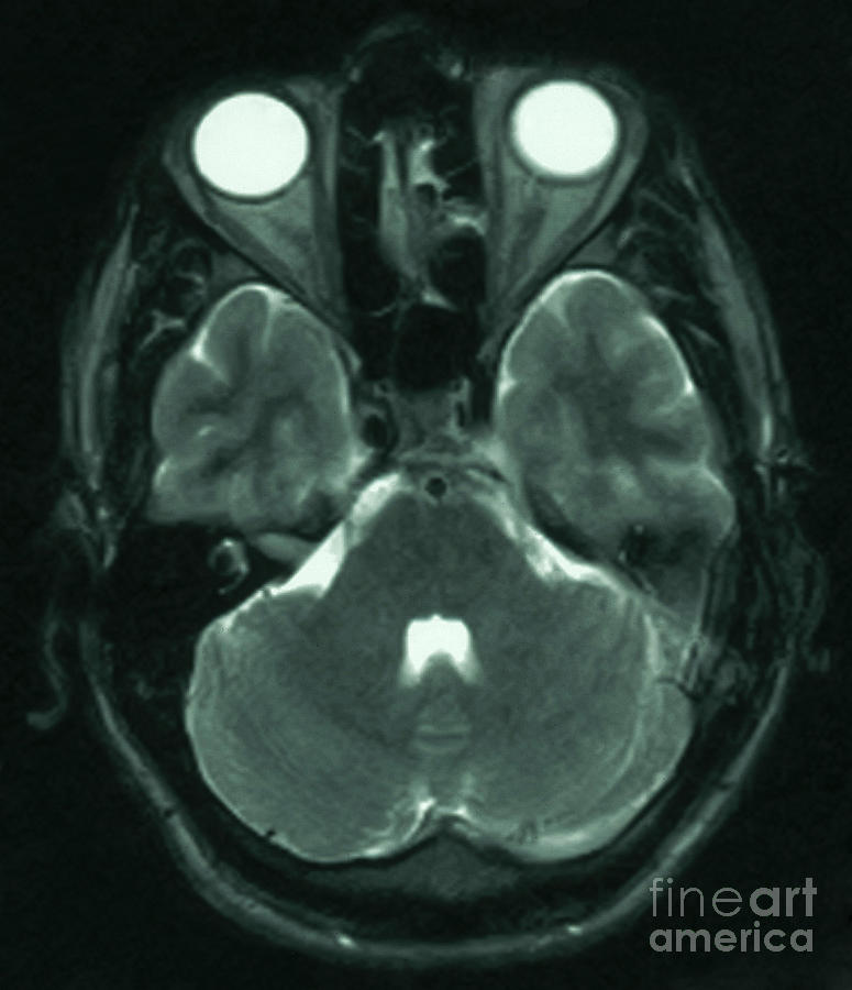 Mri Showing Normal Brain Photograph by Science Source - Fine Art America