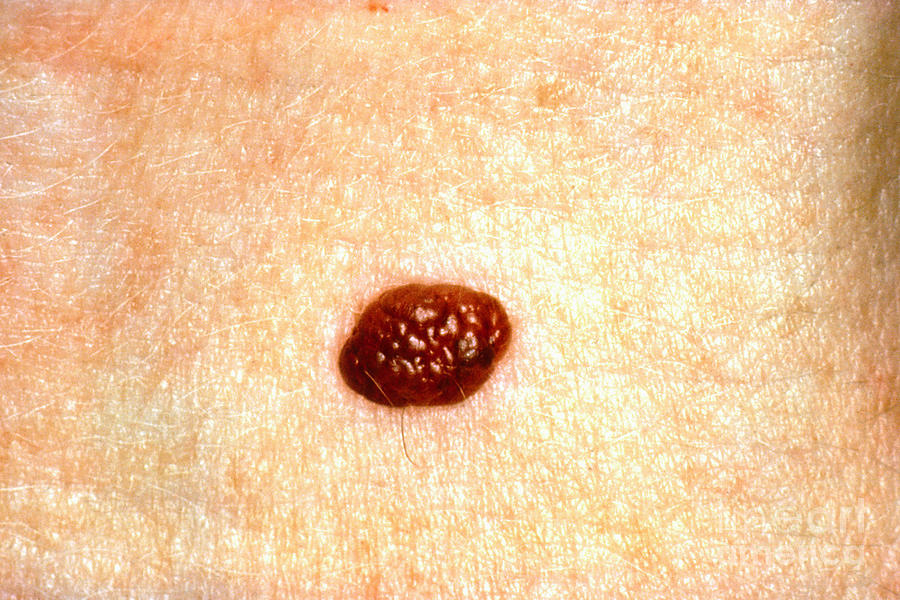 Normal Mole by Science Source