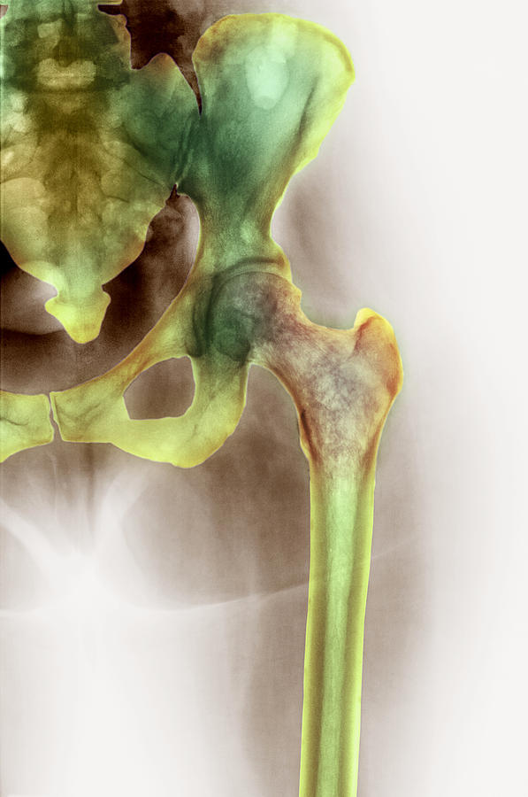 Osteoporosis Of The Hip, X-ray Photograph by