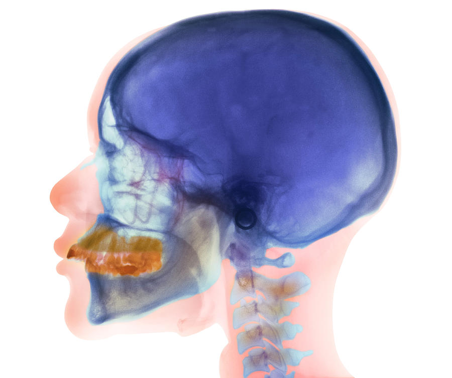 Overbite, X-ray by Science Photo Library