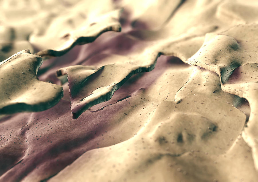 Psoriasis by Science Photo Library