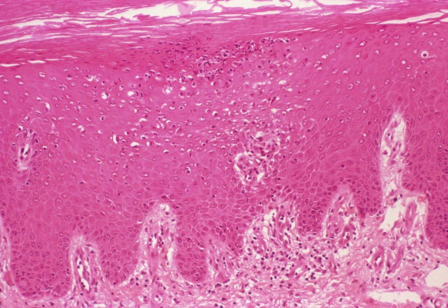 Psoriasis, Light Micrograph Photograph by Cnri - Fine Art America