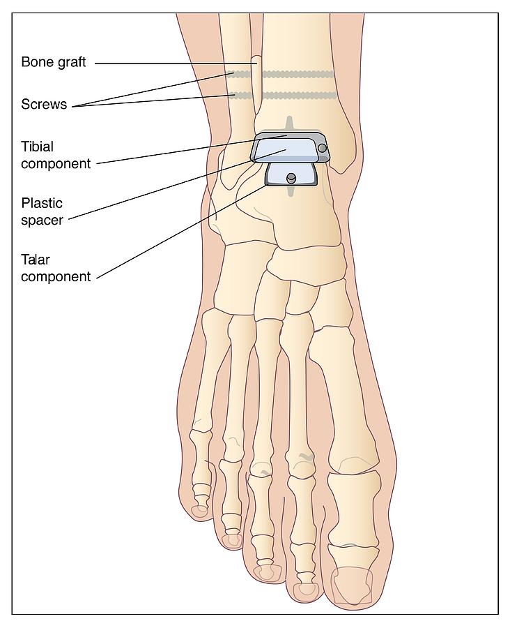 Replacement Ankle Joint, Artwork Photograph by Peter Gardiner - Fine ...