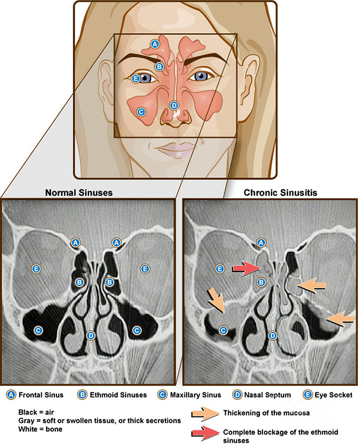 Sinuses And Sinusitis Photograph by Science Source - Fine Art America