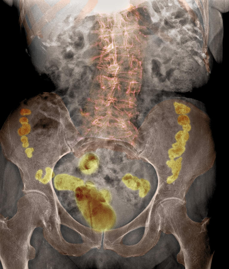 Spinal Osteoporosis, X-ray Photograph by Du Cane Medical Imaging Ltd