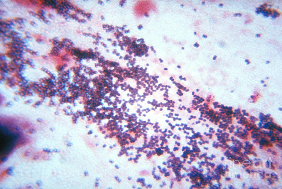 Staphylococcal Pneumonia, Lm Photograph by Science Source - Pixels