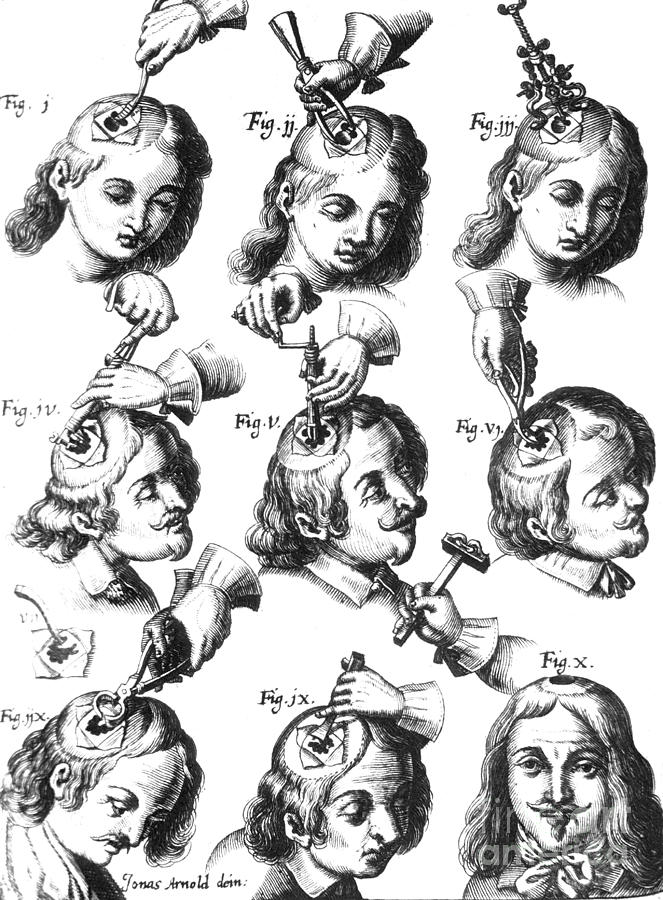 Trepanning, 1666 Photograph by Science Source - Fine Art America