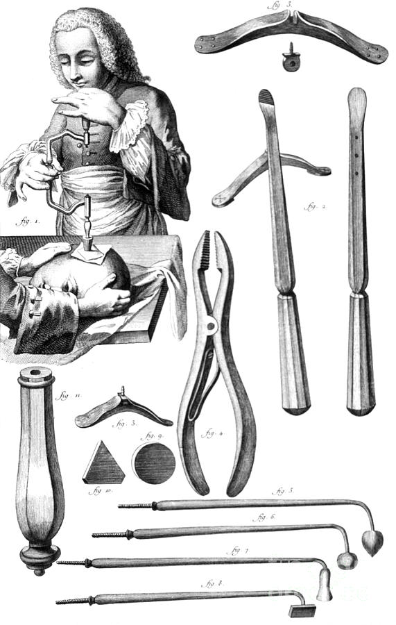 Trepanning, 1772 Photograph by Science Source - Fine Art America
