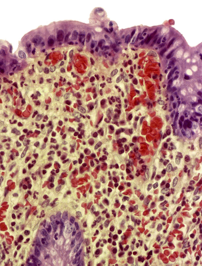Ulcerative Colitis, Light Micrograph by Science Photo Library