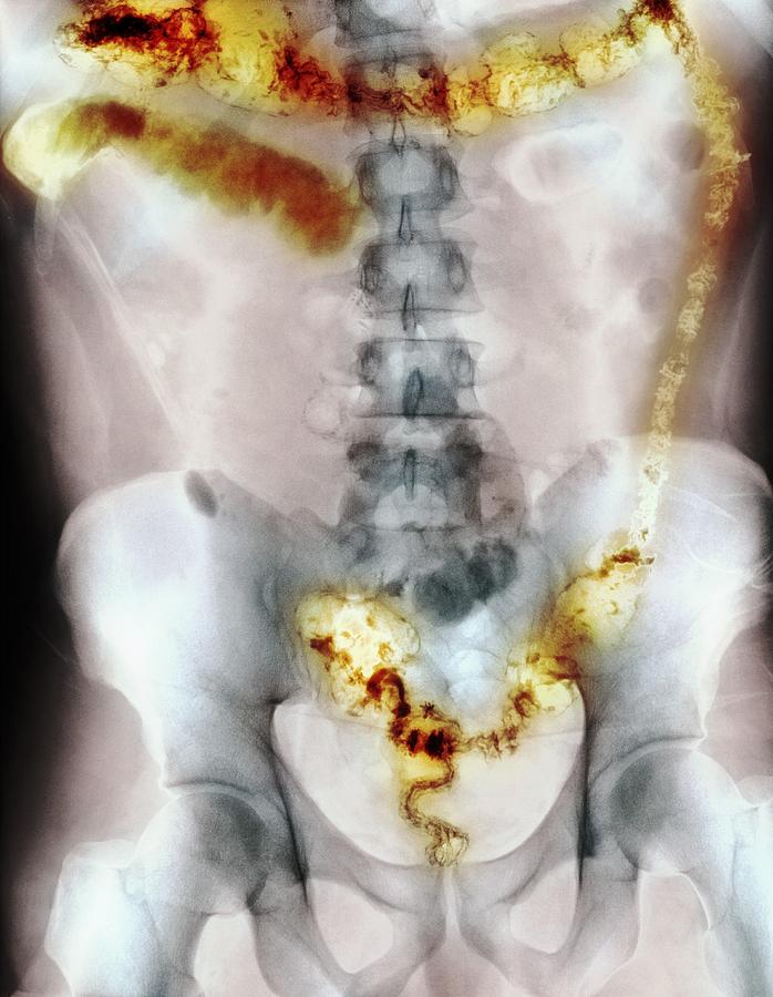 Ulcerative Colitis, X-ray by Science Photo Library