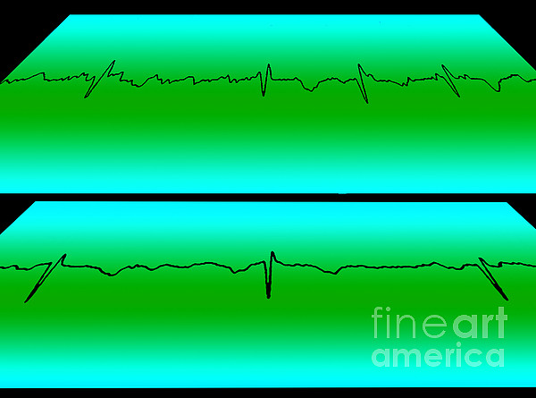 Atrial Flutter & Normal Heart Beat #1 Tapestry by Science Source ...