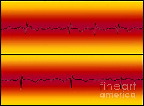 Atrial Flutter and Normal Heart Beat Greeting Card by Science Source