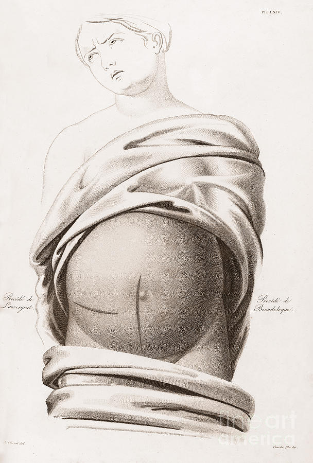 Cesarean Section Incisions Photograph By Wellcome Images Pixels