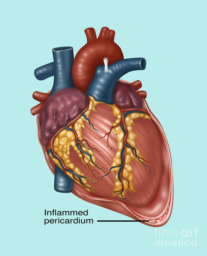 Heart With Pericarditis, Illustration Photograph by Gwen Shockey