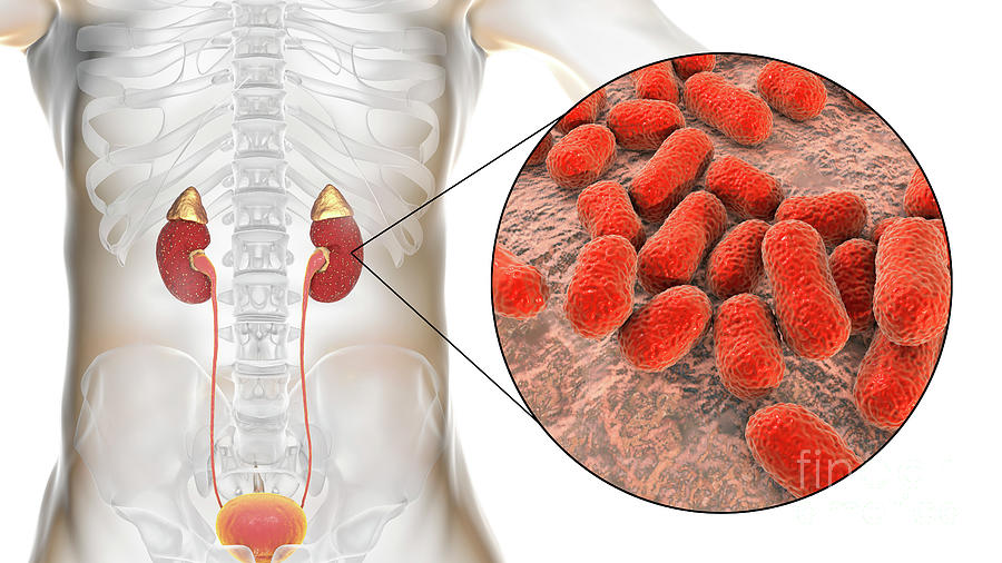 Acute Pyelonephritis Caused By Acinetobacter Bacteria Photograph by ... Acute Pyelonephritis Caused By Acinetobacter Bacteria Photograph by ...