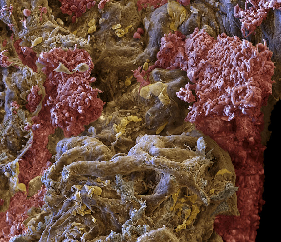 Adenocarcinoma Of The Lung, Sem Photograph by Meckes/ottawa - Fine Art ...