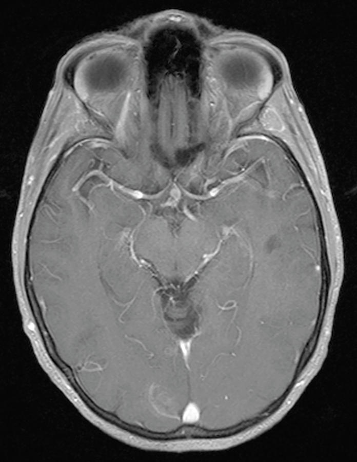 Brain Cancer Treated Mri Photograph By Steven Needell Fine Art America