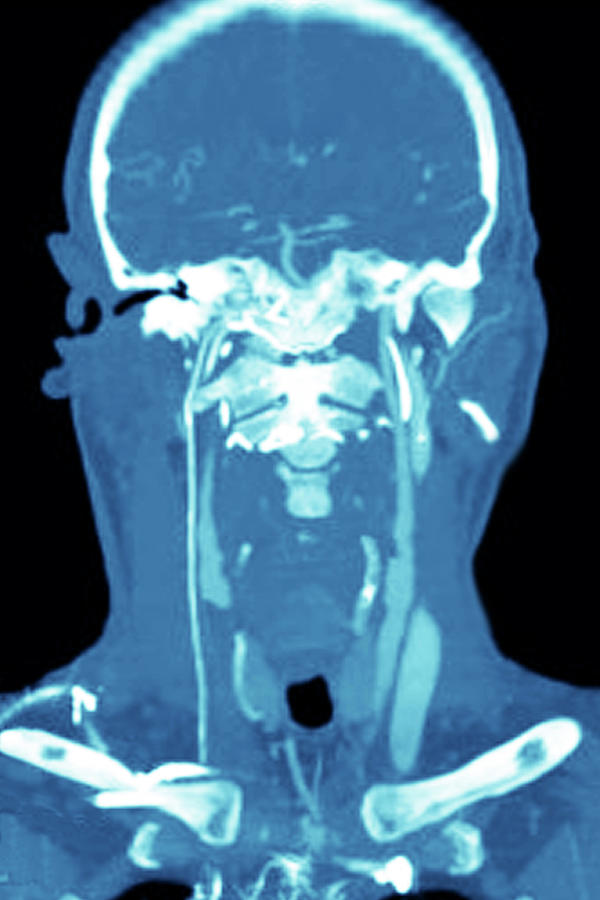 Carotid Thrombosis Photograph by James Cavallini | Pixels Carotid Thrombosis Photograph by James Cavallini | Pixels