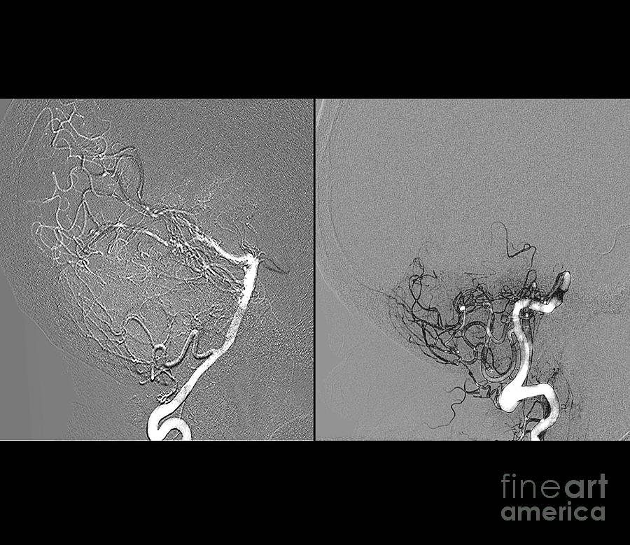 Healthy And Blocked Artery #1 by Science Photo Library