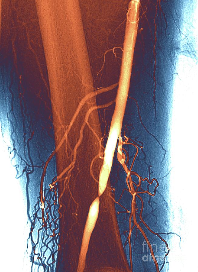 Nearly Blocked Femoral Artery Photograph by Zephyr/science Photo Library - Fine Art America