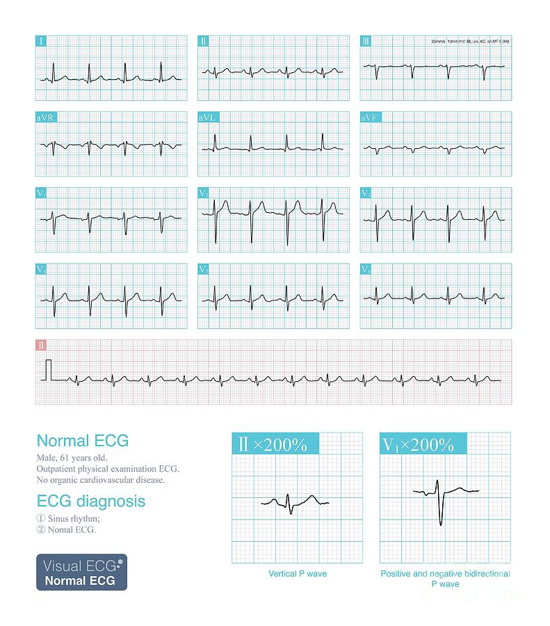 Normal Ecg Photograph by Chongqing Tumi Technology Ltd/science Photo ...