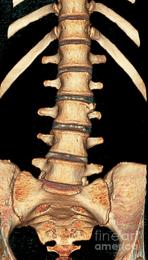 Spinal Bone Protrusion #1 by Science Photo Library