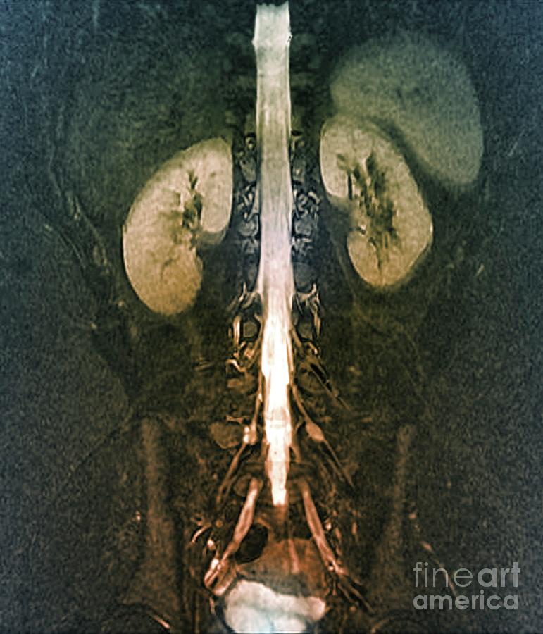 Tarlov Cyst Lumbar Spine Hot Sex Picture