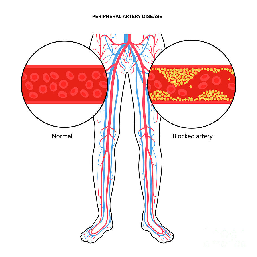 Peripheral Artery Disease Photograph By Pikovit Science Photo Library