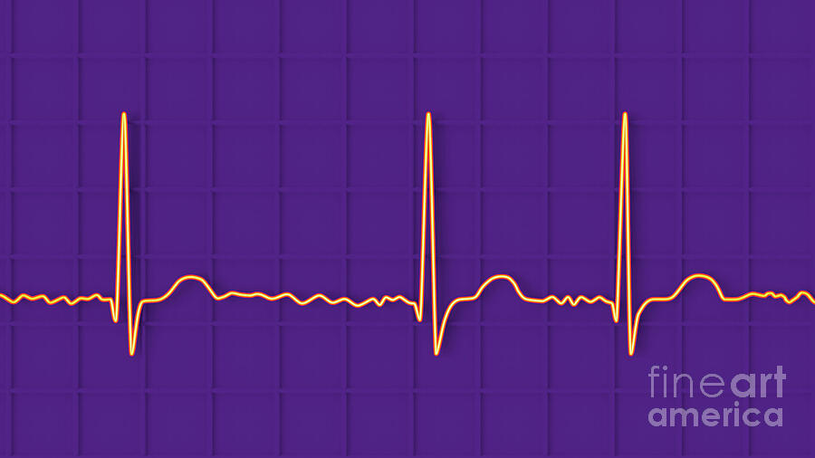Atrial Fibrillation Irregular Heartbeat Rhythm #12 by Kateryna Kon/science Photo Library