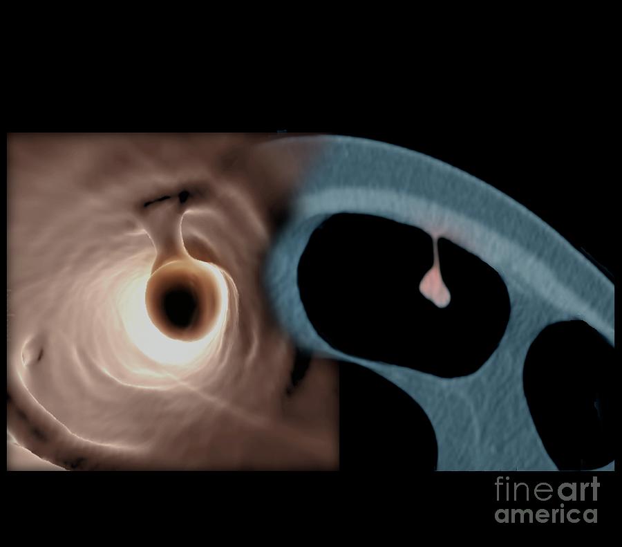 Colorectal Polyp Photograph By Zephyr Science Photo Library Pixels