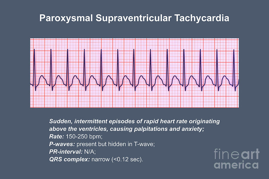 Supraventricular Tachycardia Heartbeat Rhythm #13 by Kateryna Kon/science Photo Library