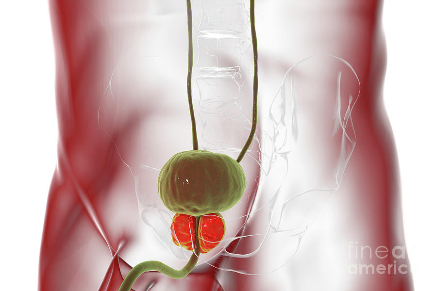 Benign Prostatic Hyperplasia Photograph By Kateryna Kon Science Photo