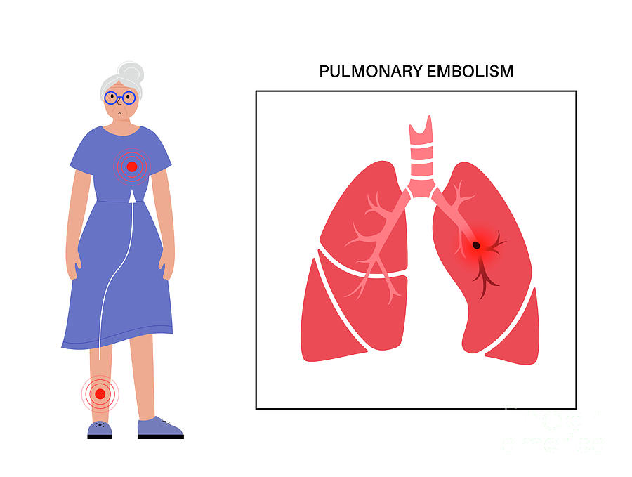 Pulmonary Embolism Photograph by Pikovit / Science Photo Library - Fine Art America