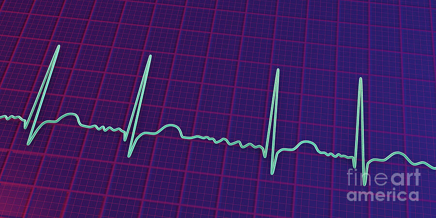 Atrial Fibrillation Irregular Heartbeat Rhythm #15 by Kateryna Kon/science Photo Library