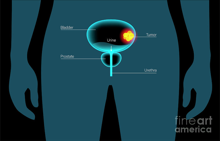 Bladder Cancer Stages 15 Photograph By Pikovit Science Photo Library