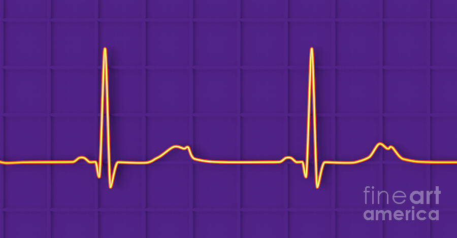 Long Qt Syndrome Type 2 Electrocardiogram #15 by Kateryna Kon/science ...