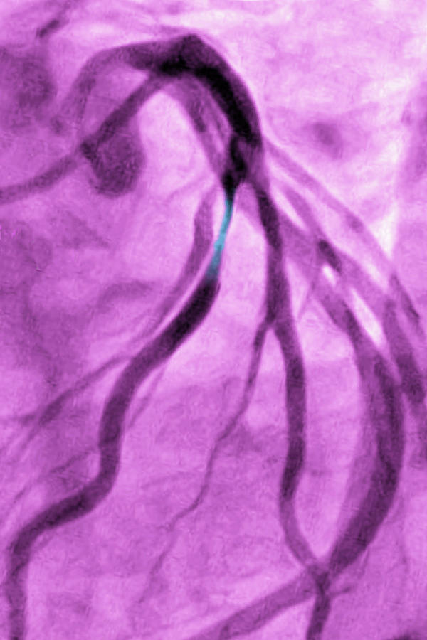 Angina Pectoris Photograph by James Cavallini - Pixels Angina Pectoris Photograph by James Cavallini - Pixels