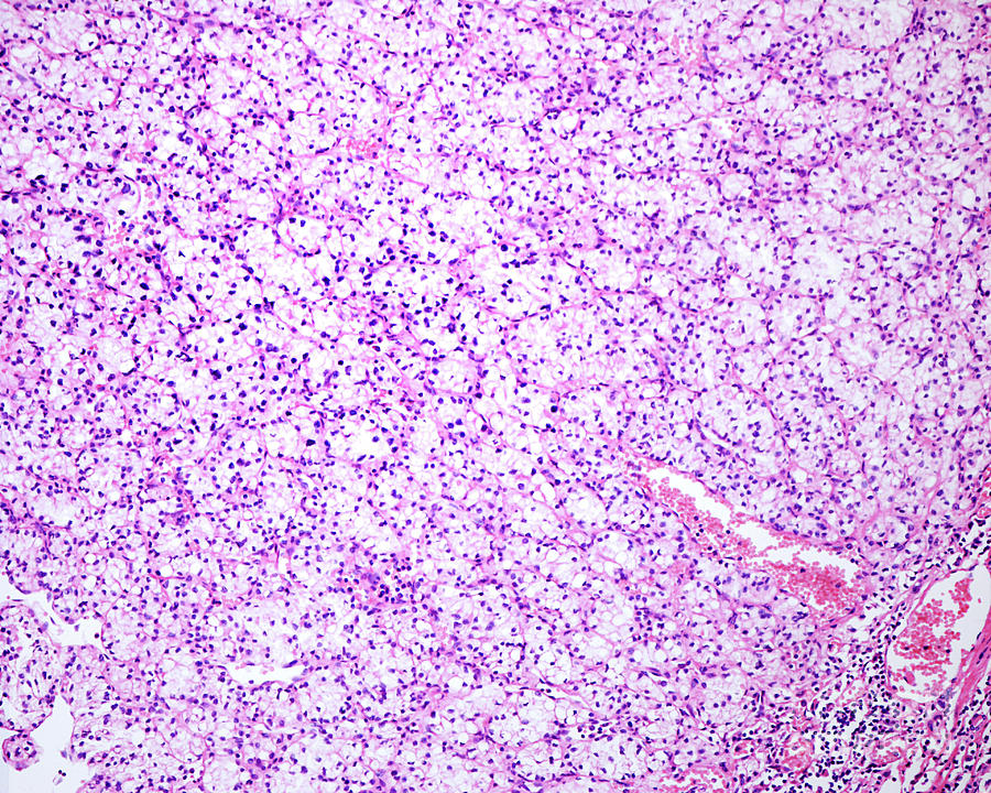 Clear Cell Renal Carcinoma 2 By Jose Calvo Science Photo Library